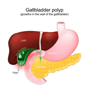 Can Gallbladder Issues Cause Weight Gain? {Expert Advice}